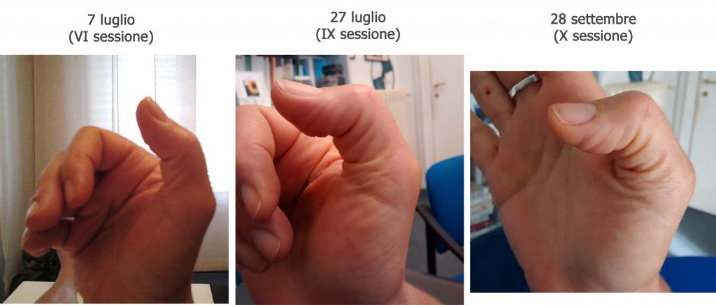 Dito a Scatto prima e dopo (CC)